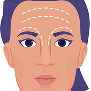 Cirugía Lifting – Clínica Saint Paul – Clínica Saint Paul